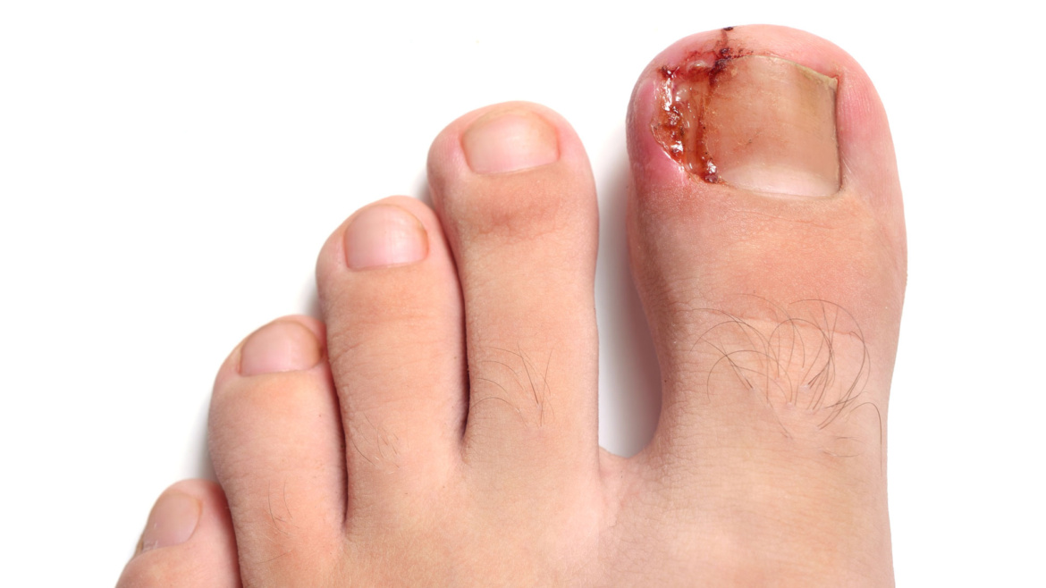 INGROWING TOENAILS….OUCH! | Foot Centric Staffordshire